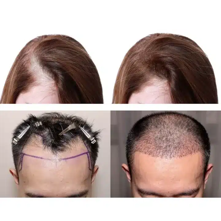 Hair Transplant - Avana Cosmetic & Laser Clinic